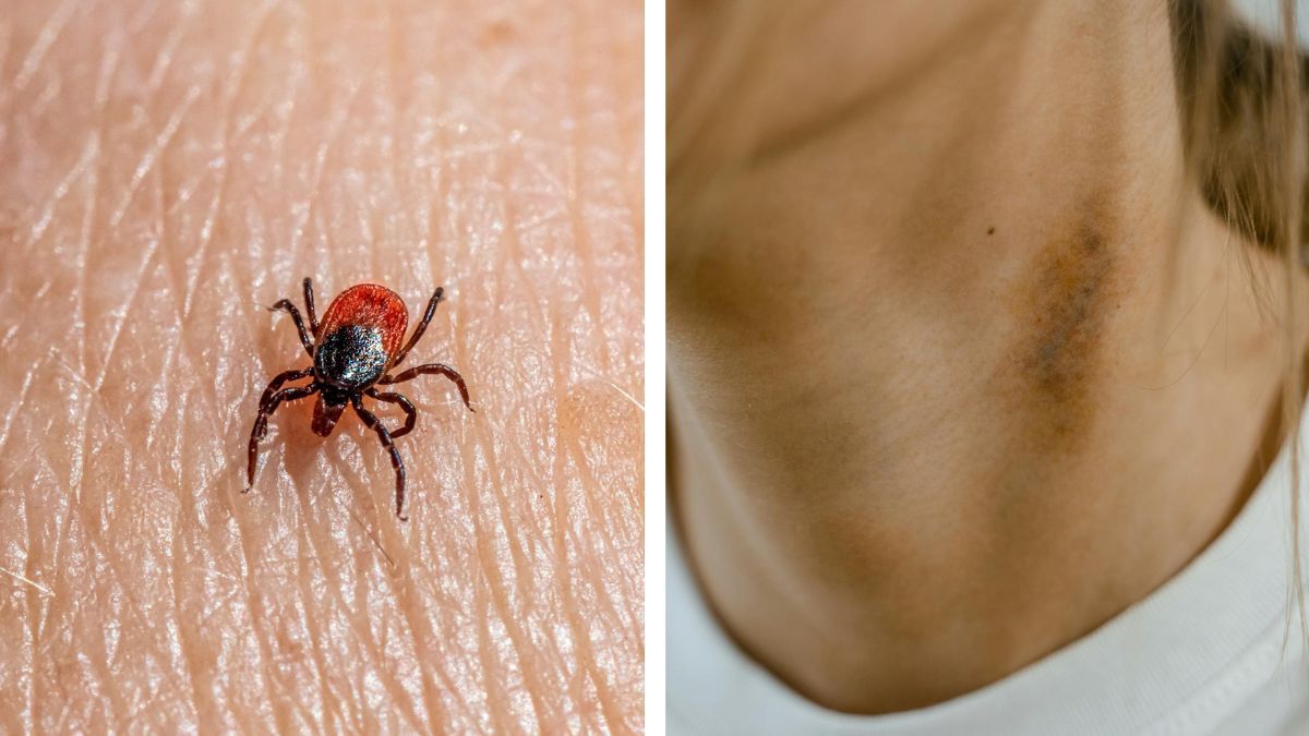 O que é doença de lyme? Saiba se tem cura e se é comum em carrapatos no ...