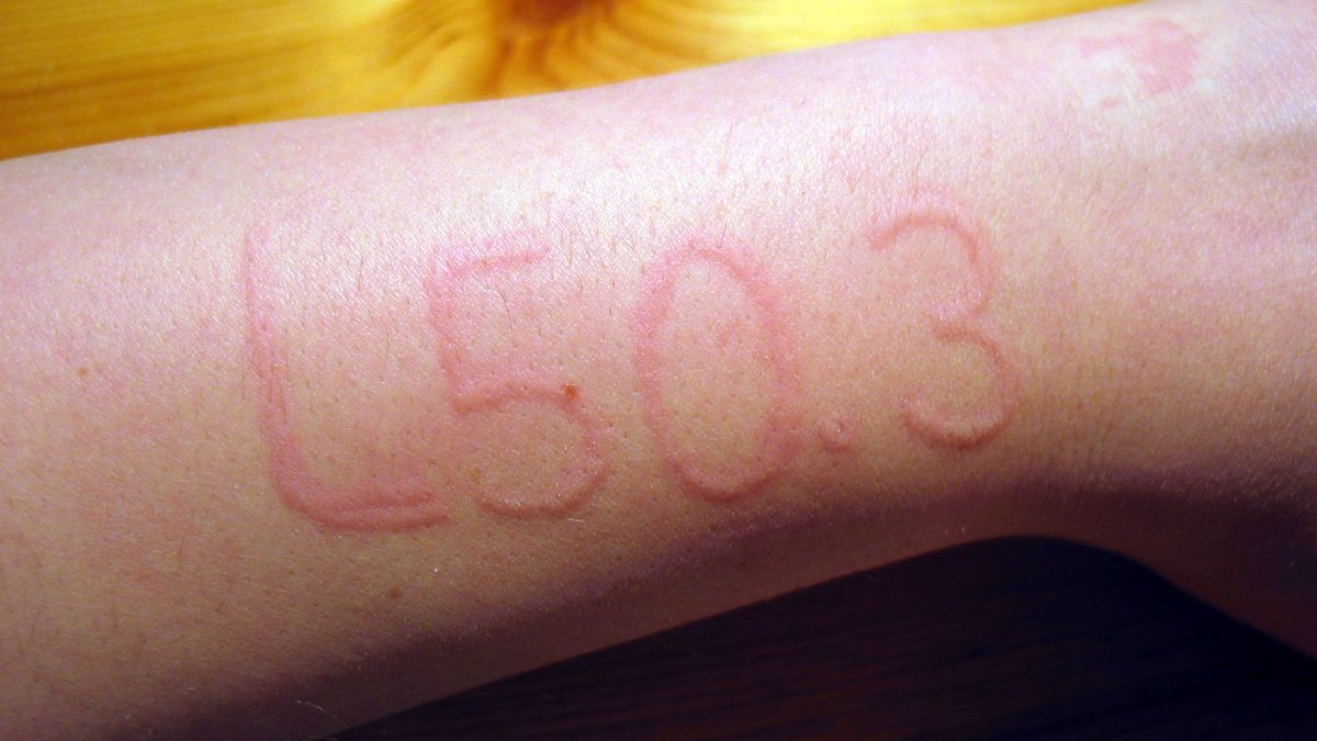 Dermatografismo: condição rara permite escrever na pele - Canaltech